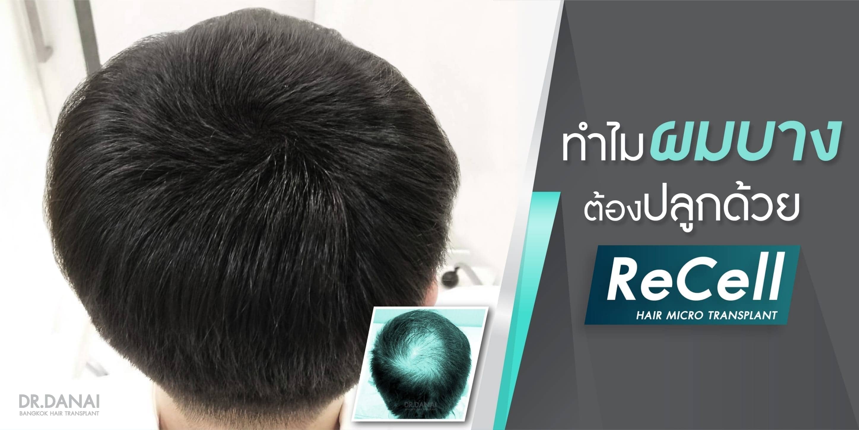 ทำไมผมบางต้องปลูกด้วย ReCell - BEQ CLINIC คลินิกปลูกผม