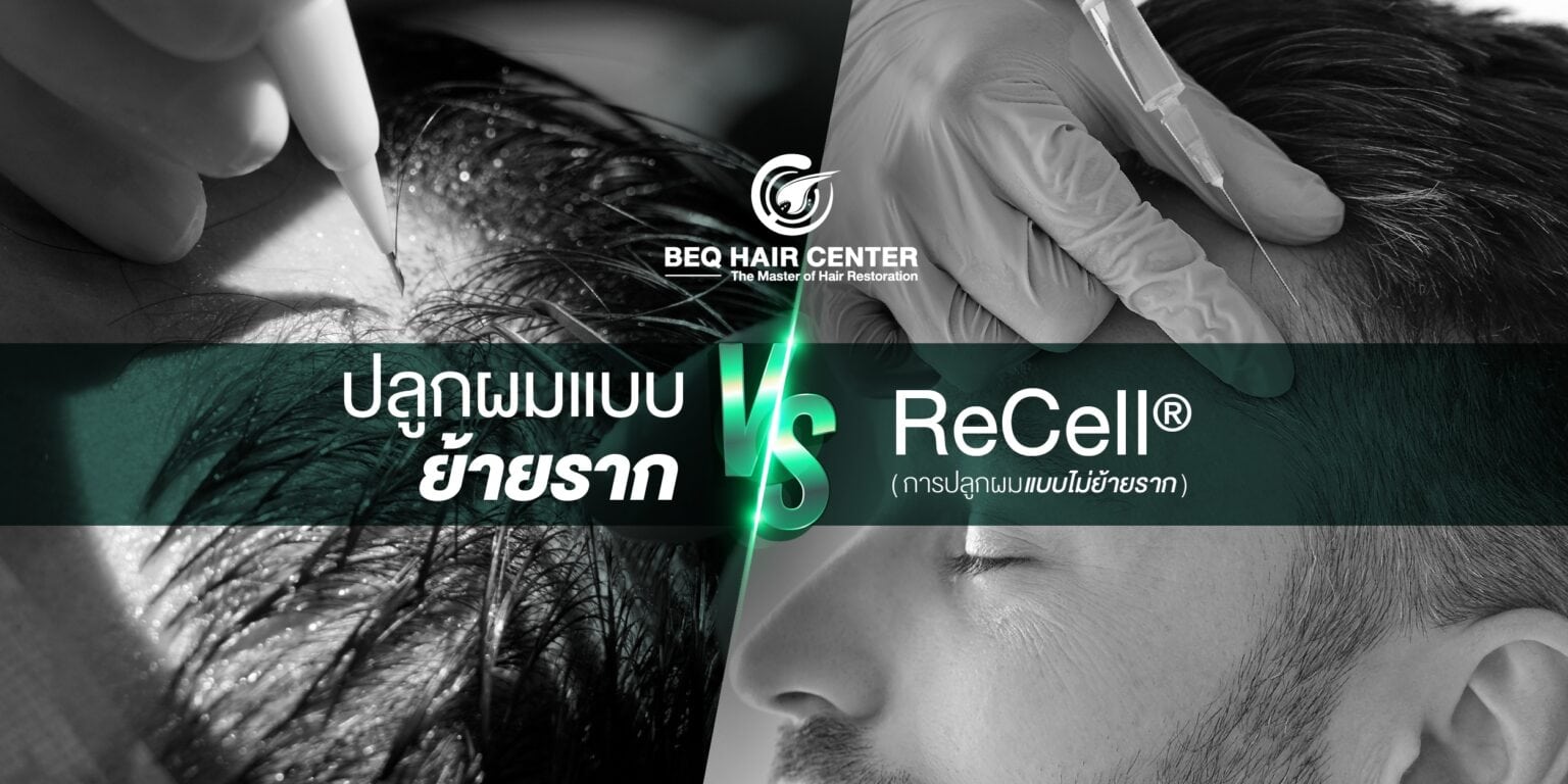 Differences in FUE vs ReCell® Hair Transplant Guide